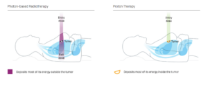 About Proton Radiation Therapy | UAMS Health