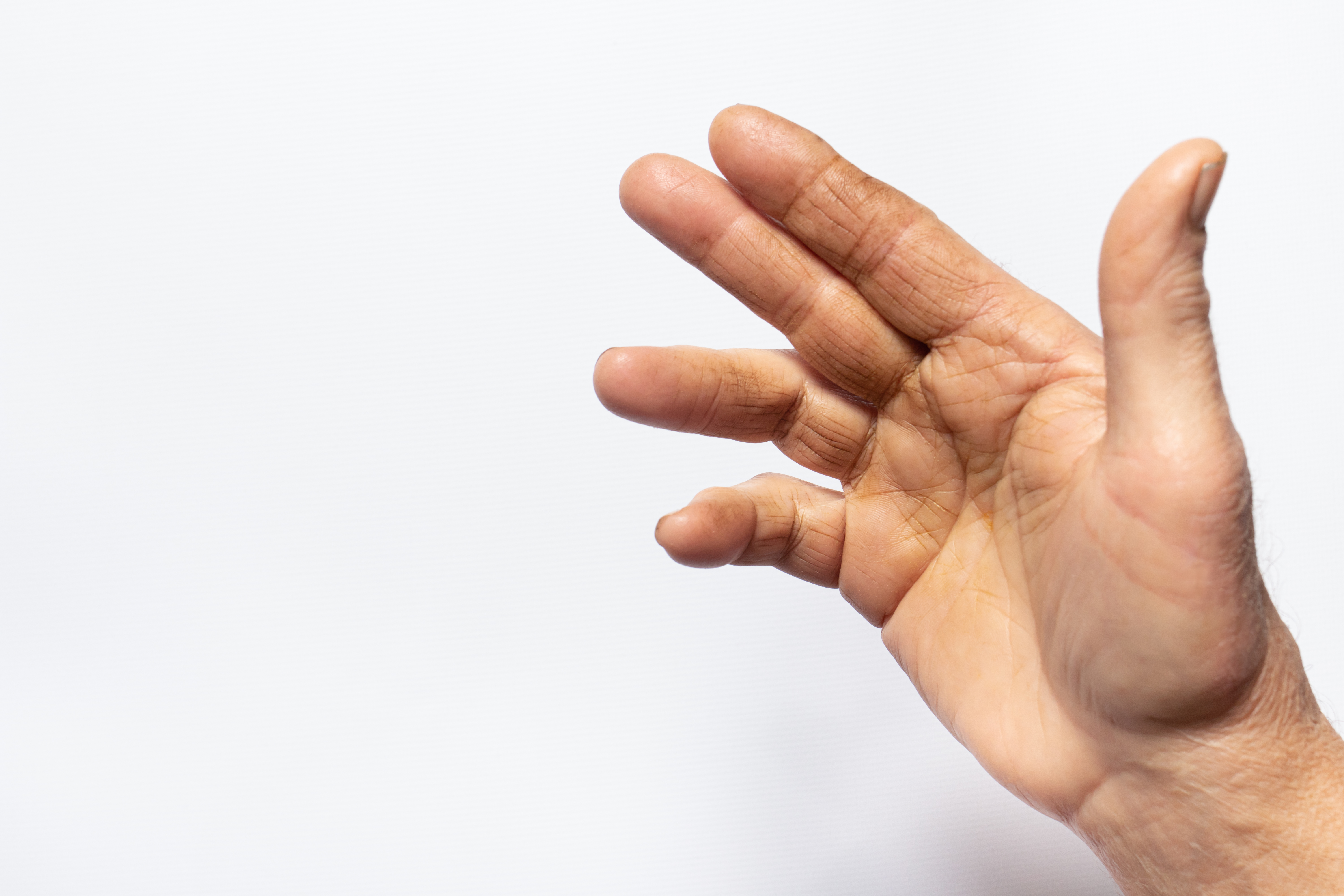 Dr. Theresa Wyrick Explains Dupuytren’s Disease: Symptoms & Non ...
